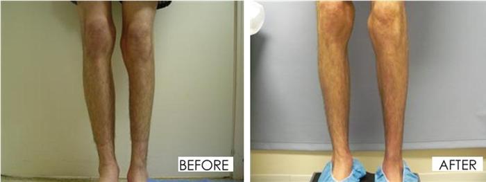 Calf Implants - Male Muscle Augmentation, Long Beach, Los Angeles