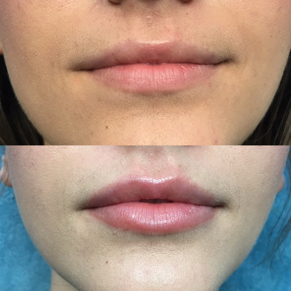 Orange Lip Swelling